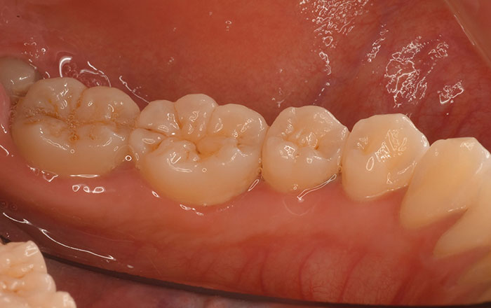 🎊 歯茎 に 黒い 点 | 歯 黒い点 歯磨きで消える – Vishuji